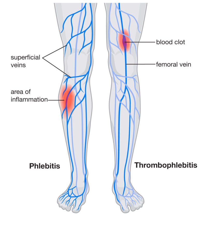 Phlebitis & Blood Clots: Symptoms, Risks & Treatment | PVG